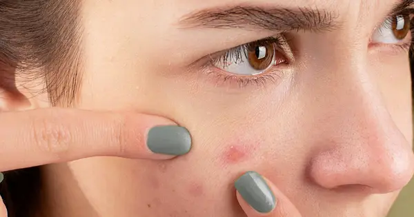 Is Your Gut Behind Bloating, Acne, and Brain Fog?