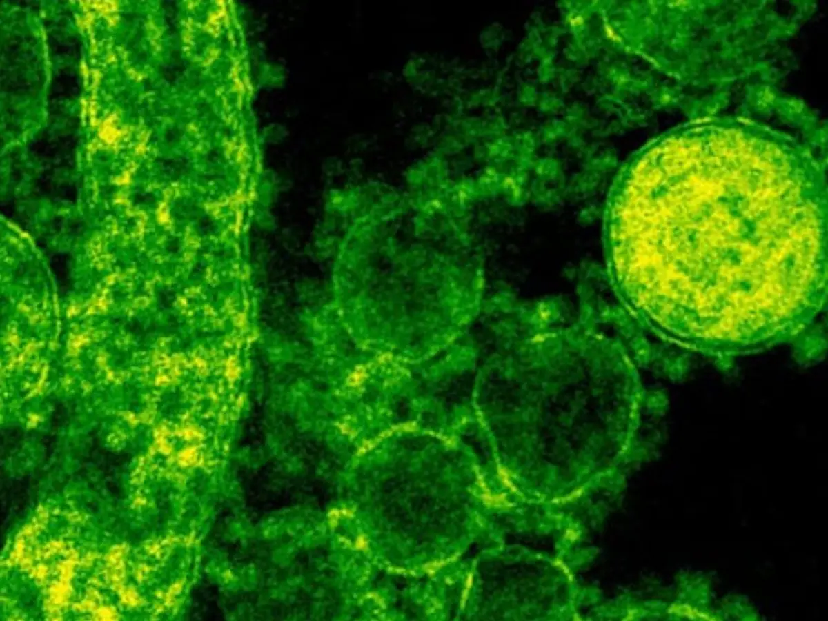 India: 22-year-old reportedly succumbs to Guillain-Barre Syndrome in West Bengal, Death toll ...